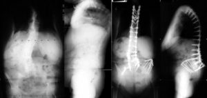 Vertebral Column Resection - Scoliosis and Spine Associates