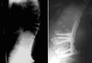 Flatback Syndrome - Scoliosis and Spine Associates