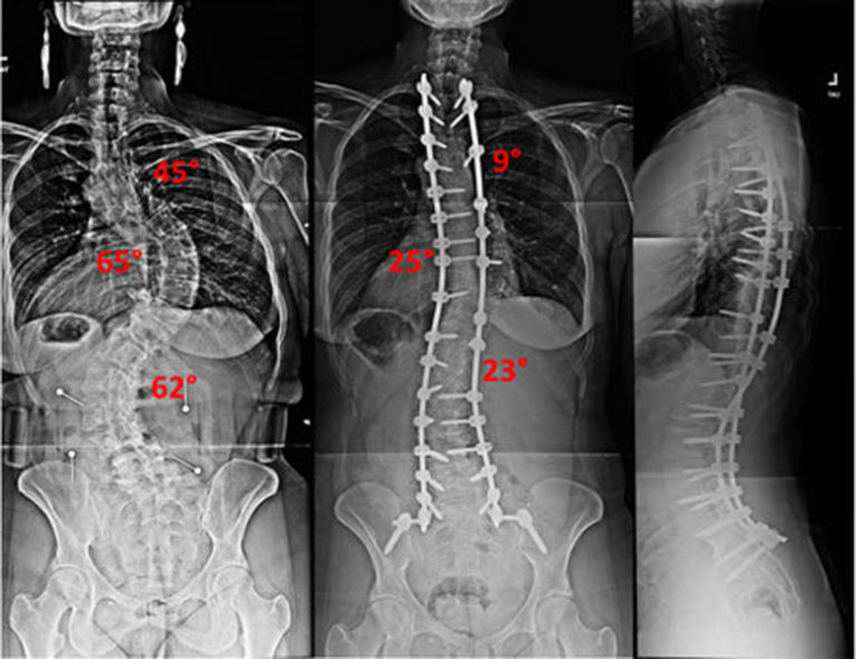 Adult Spinal Deformity | Treatment, Surgery, Therapy | NJ & NYC