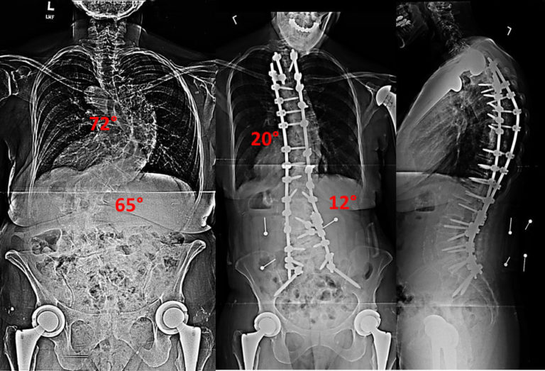 Adult Spinal Deformity | Treatment, Surgery, Therapy | NJ & NYC