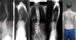Marfan Syndrome - Scoliosis and Spine Associates